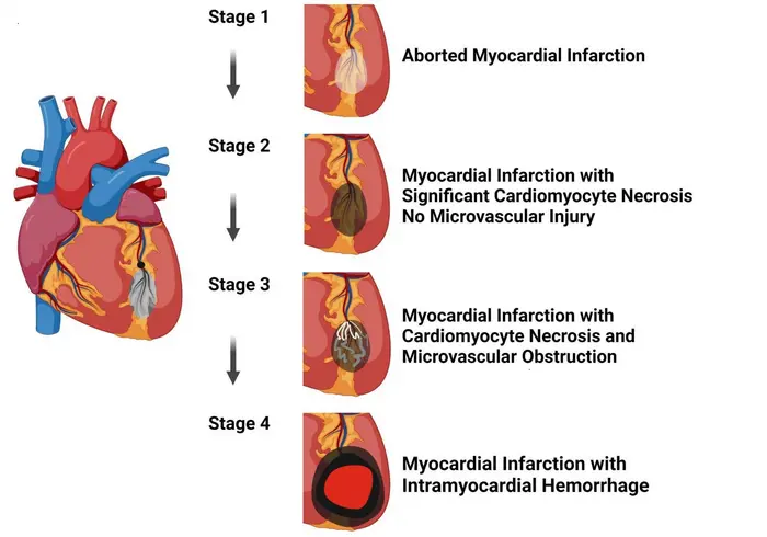 First classification of four stages of heart attack based on heart ...